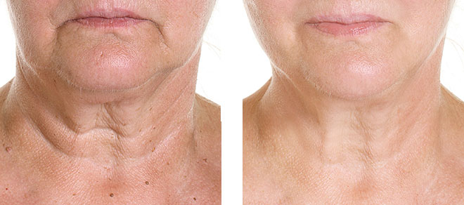 botox-jaw-line-definition | The London Facial Care