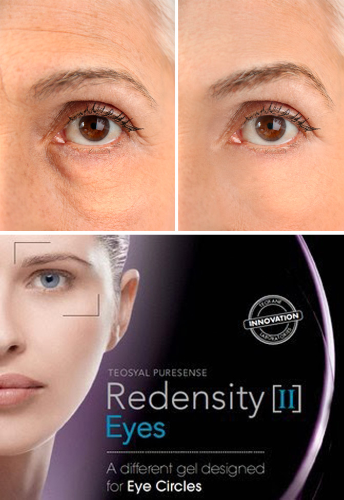 TEOSYAL REDENSITY II FOR A REFRESHED LOOK | The London Facial Care