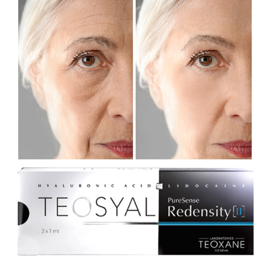 Teosyal redensity II dermal filler before after result - The ...