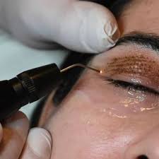 WHAT IS PLASMAGE AND WHAT IS IT USED FOR? | The London Facial Care