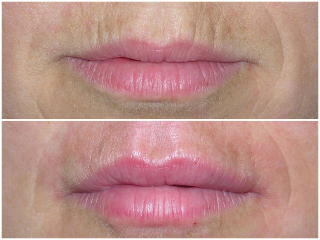 lips before after plasmage at thelondonfacialcare with dr Fern | The ...