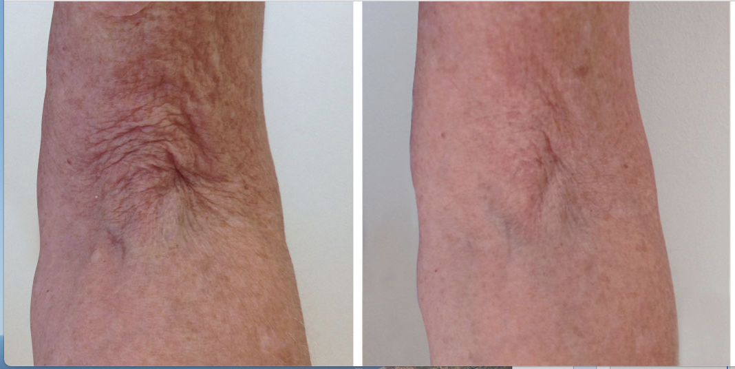 Before after profhilo arms | The London Facial Care