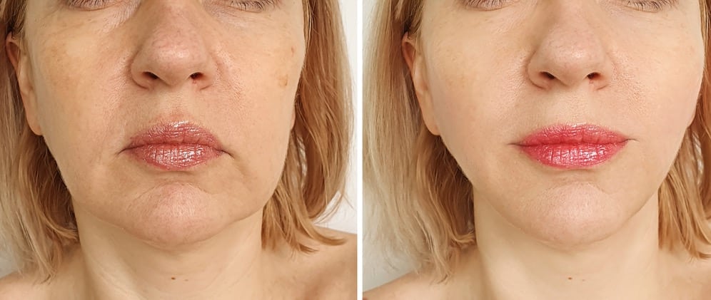 Woman,Face,Lift,After,Treatment | The London Facial Care
